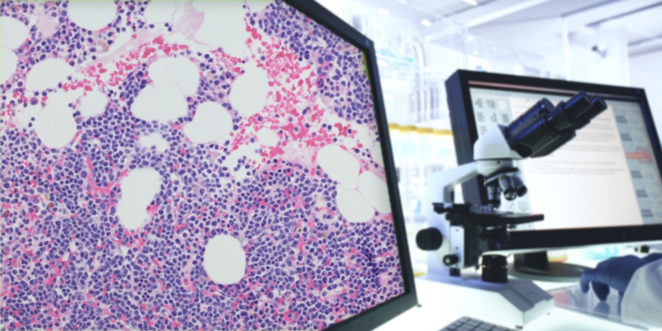 ASH Highlights Study Updates in Smoldering Multiple Myeloma | The IMF ...